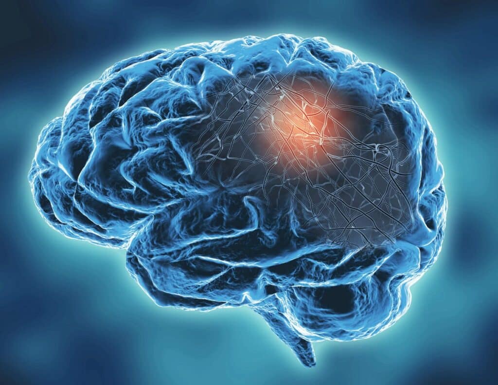 Understanding Coup-Contrecoup Brain Injuries | Distasio Law Firm